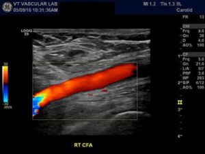 Peripheral Arterial Duplex Examination - CVT
