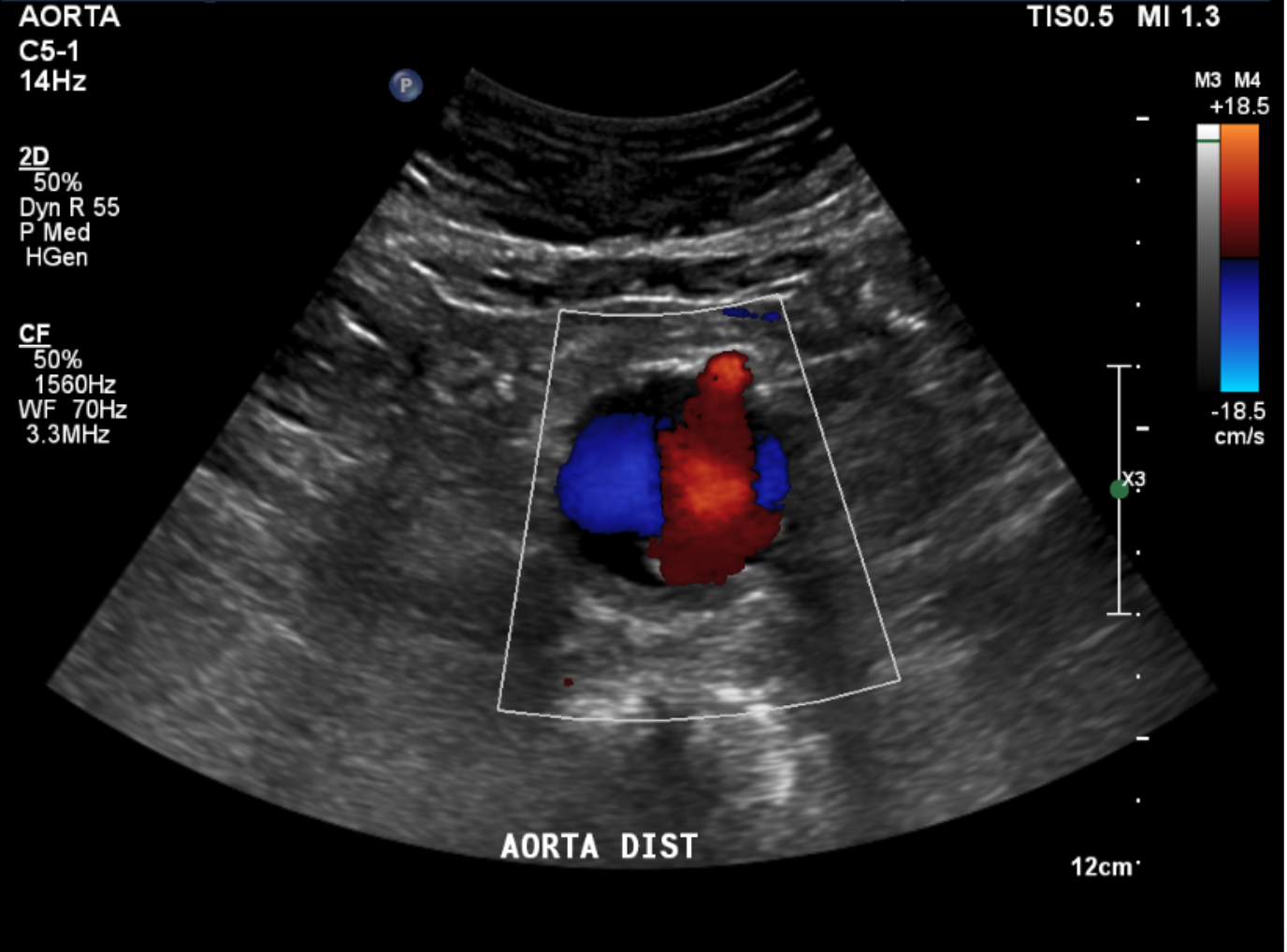 Abdominal Aortic Aneurysm (AAA) | CVT | Vein Therapy Center
