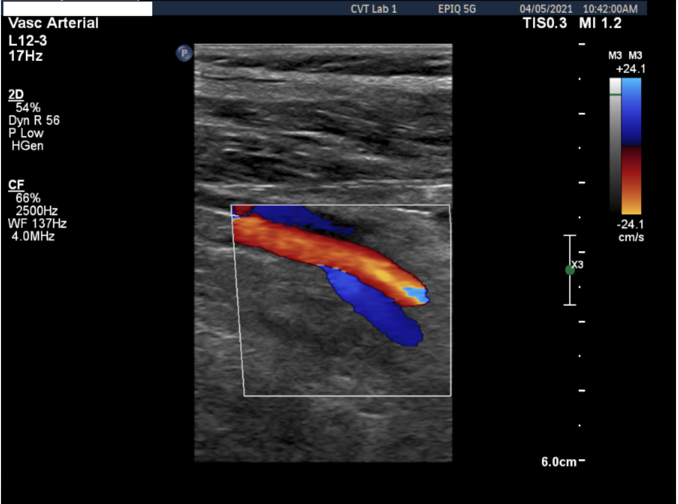 Peripheral Arterial Duplex Examination | CVT | Vascular Laboratory