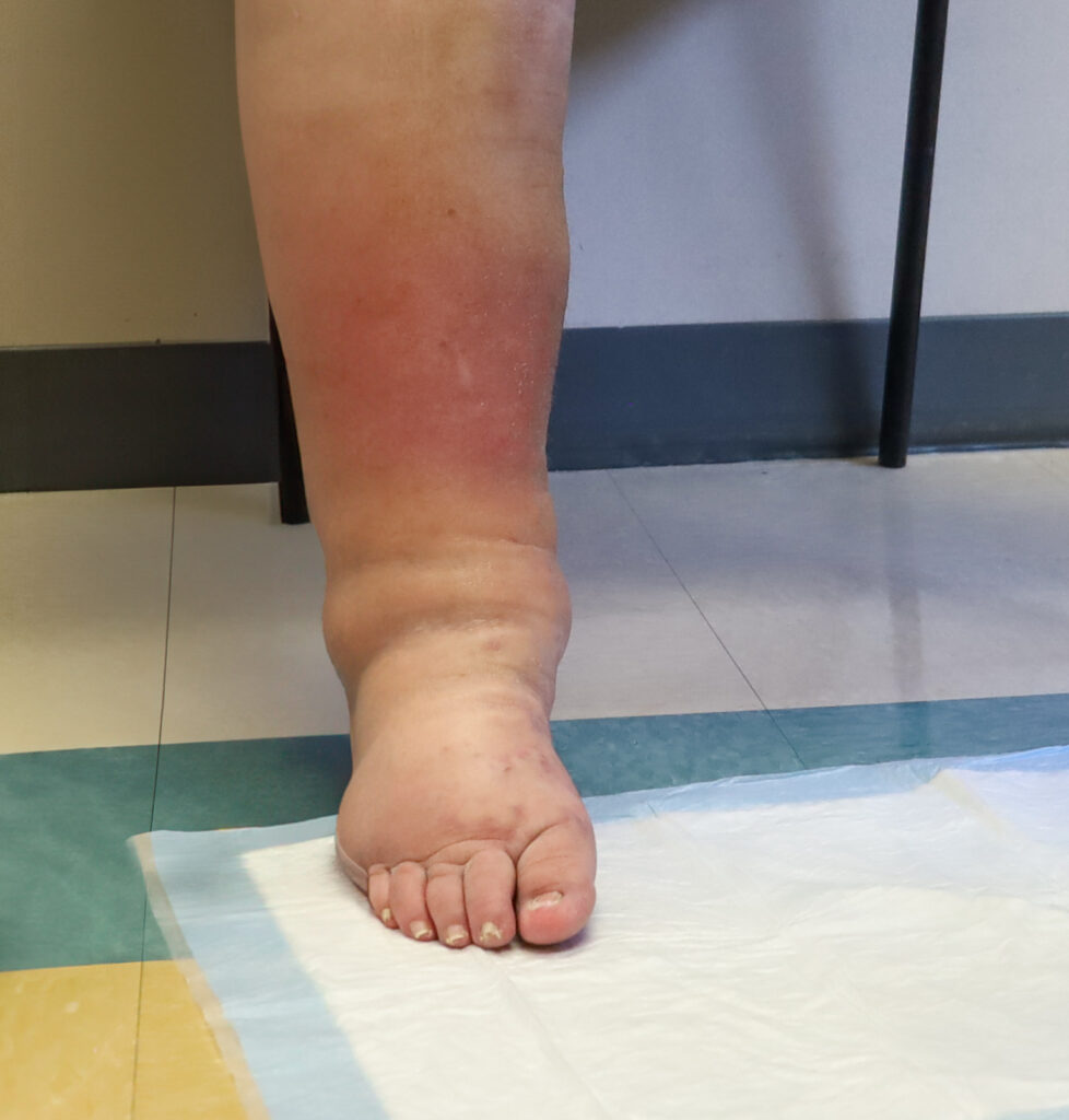 Chronic Venous Insufficiency - CVT